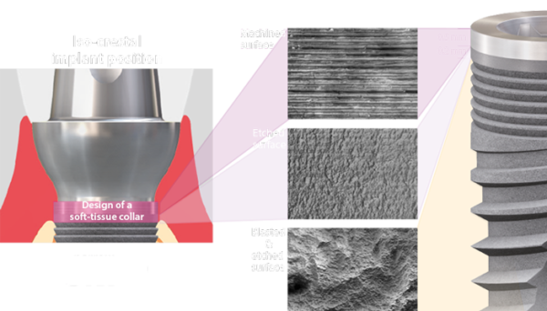 narrowSKY - The narrow bone level SKY - bredent-implants