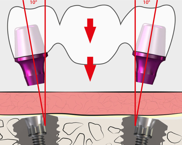 copaSKY Prosthetics - bredent-implants