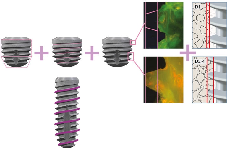 copaSKY - The conical parallel implant