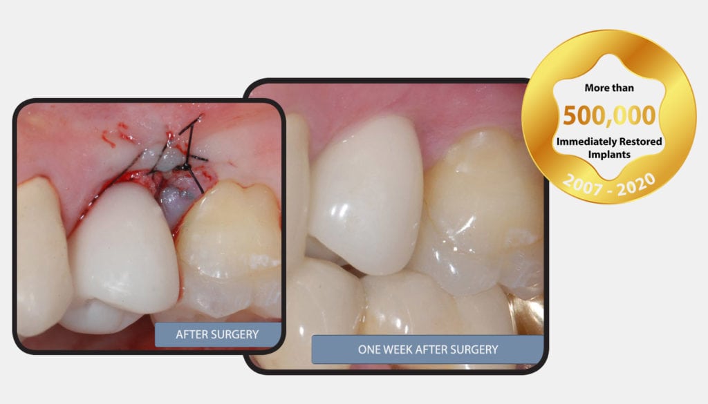 Immediate Restoration - Fast and better healing