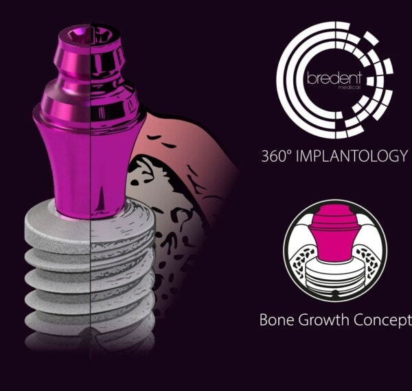 Conical connection - Bone level implants - bredent-implants